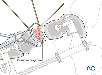 ORIF - Navicular plate for Complete articular navicular fracture