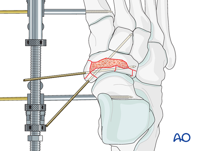 ORIF - Navicular plate for Complete articular navicular fracture