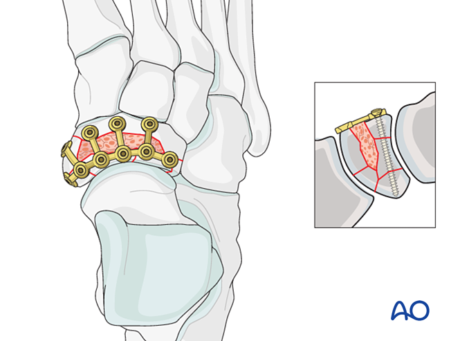 ORIF of navicular with reconstructable articular surfaces