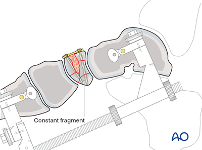 ORIF - Navicular plate for Complete articular navicular fracture