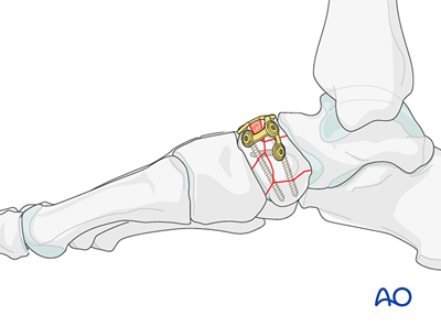 ORIF - Navicular plate for Complete articular navicular fracture