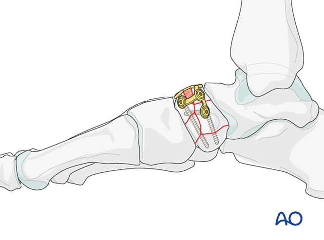 ORIF - Navicular plate for Complete articular navicular fracture