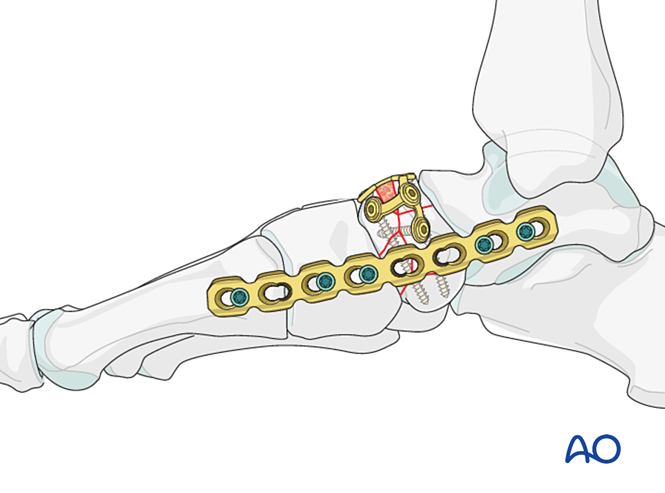 ORIF - Navicular plate for Complete articular navicular fracture