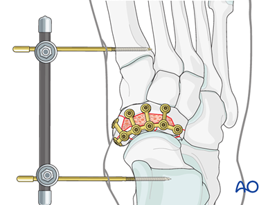 ORIF - Navicular plate for Complete articular navicular fracture