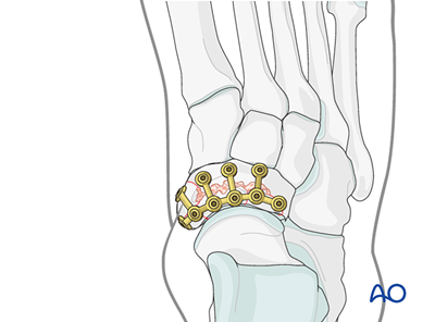 ORIF - Navicular plate for Complete articular navicular fracture