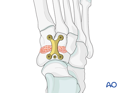Primary fusion of naviculocuneiform joint for Complete articular ...