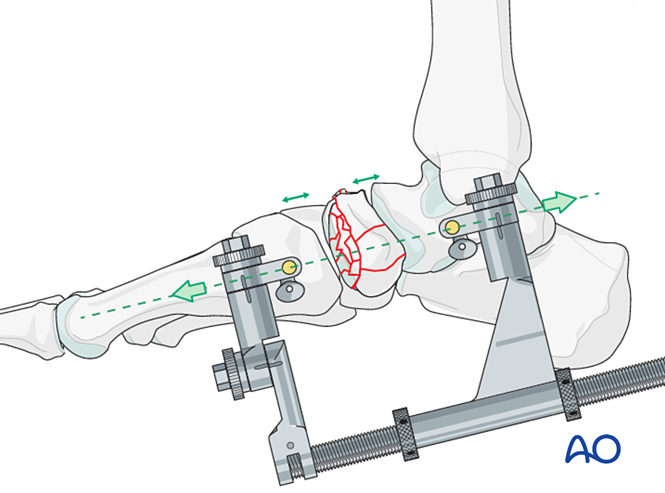 Primary fusion of naviculocuneiform joint for Complete articular ...