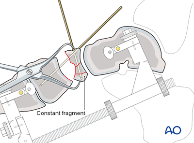 Primary fusion of naviculocuneiform joint for Complete articular ...