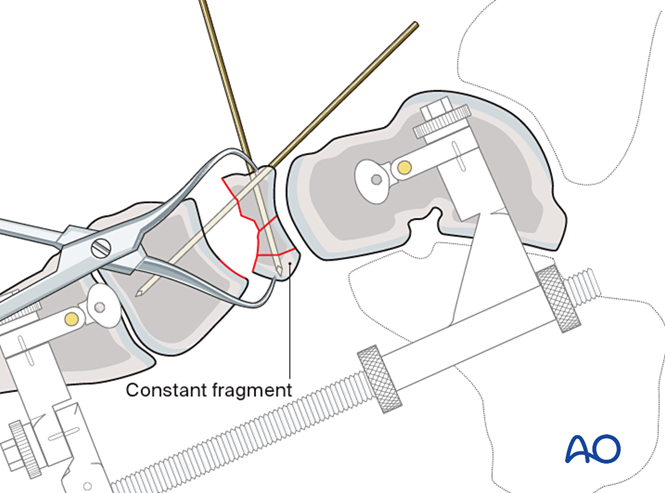 Fusion of unreconstructable naviculocuneiform joint