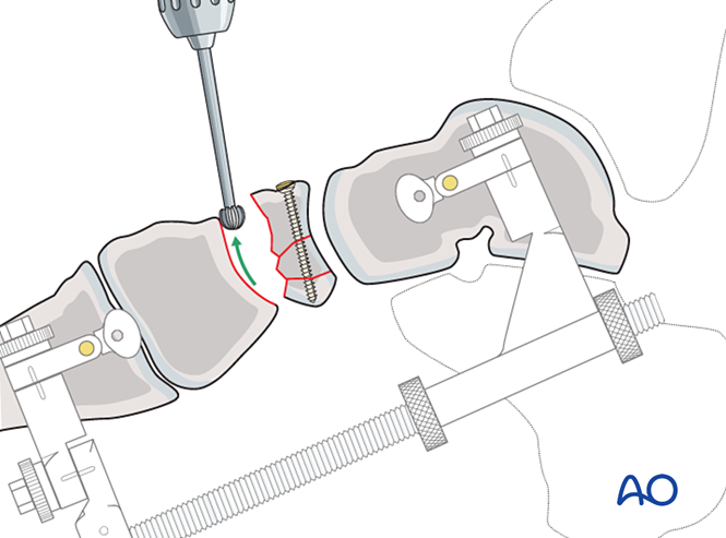 Fusion of unreconstructable naviculocuneiform joint