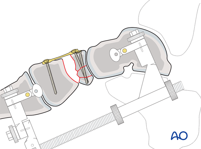 Primary fusion of naviculocuneiform joint for Complete articular ...