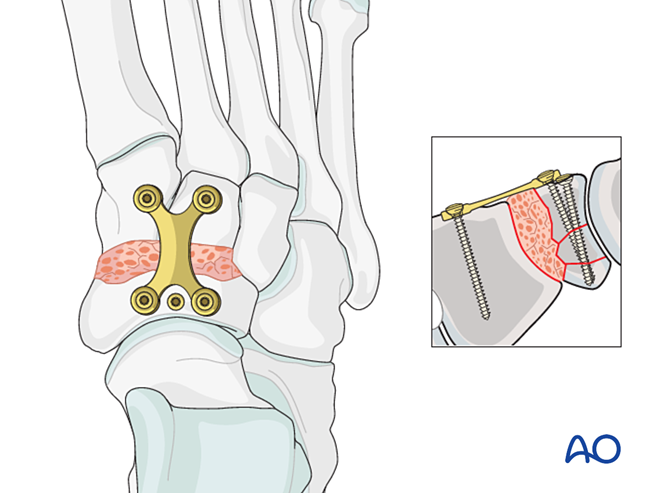 Primary fusion of naviculocuneiform joint for Complete articular ...