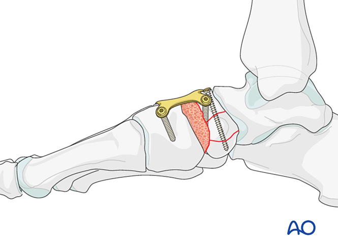 Primary fusion of naviculocuneiform joint for Complete articular ...