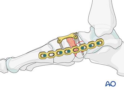 Primary fusion of naviculocuneiform joint for Complete articular ...