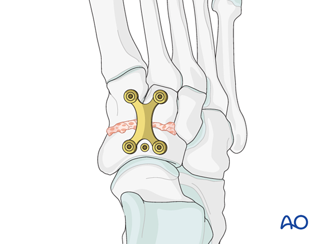 Primary fusion of naviculocuneiform joint for Complete articular ...