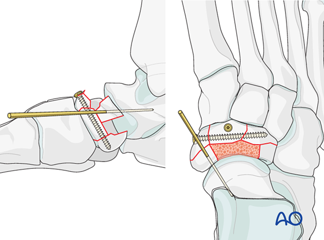 Temporary bridging of talonavicular joint for Complete articular ...