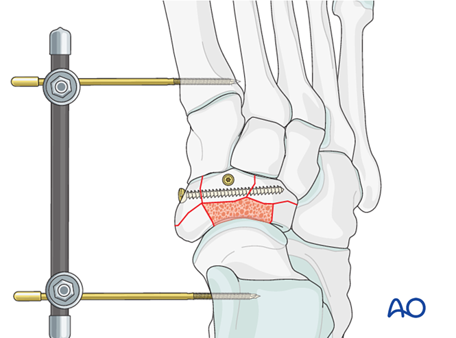 Temporary bridging of talonavicular joint for Complete articular ...