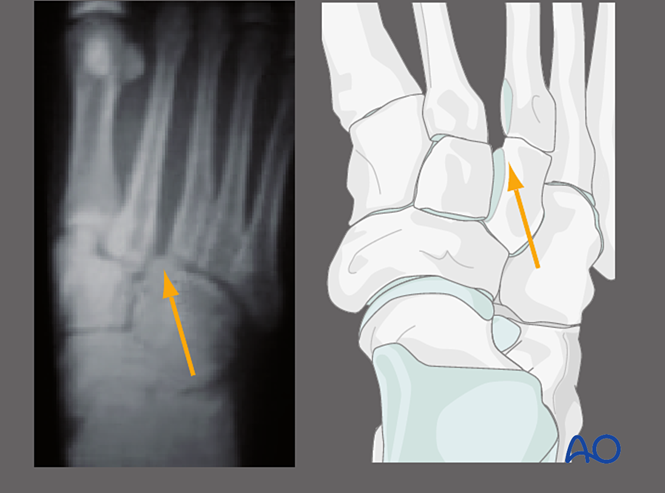 TMT (Lisfranc) injuries