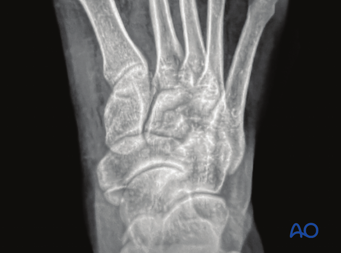 TMT (Lisfranc) injuries