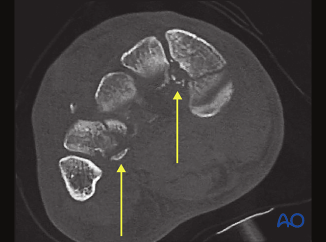 TMT (Lisfranc) injuries