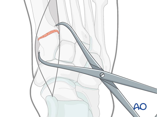 Lag screw fixation of tarsometatarsal joint