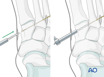 Dynamic fixation of ruptured Lisfranc ligament