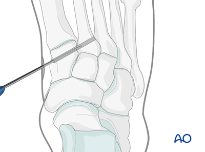 Dynamic fixation of ruptured Lisfranc ligament