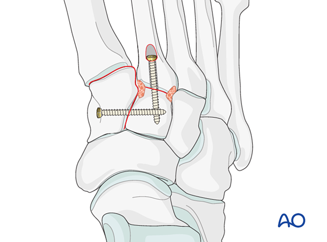 Treatment of Lisfranc injuries for Lisfranc injury