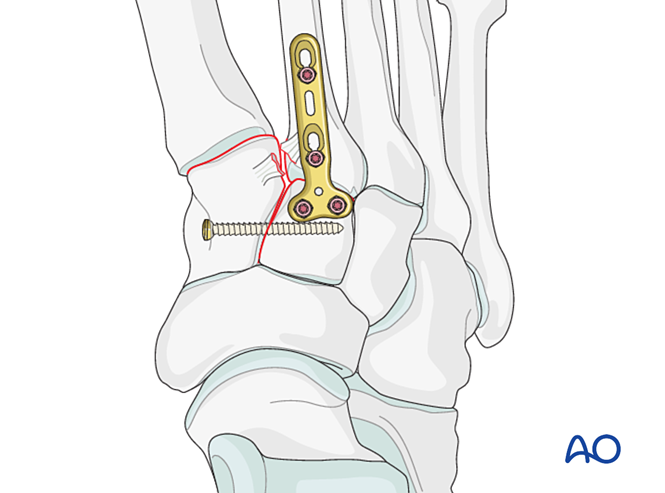 Treatment of Lisfranc injuries for Lisfranc injuries