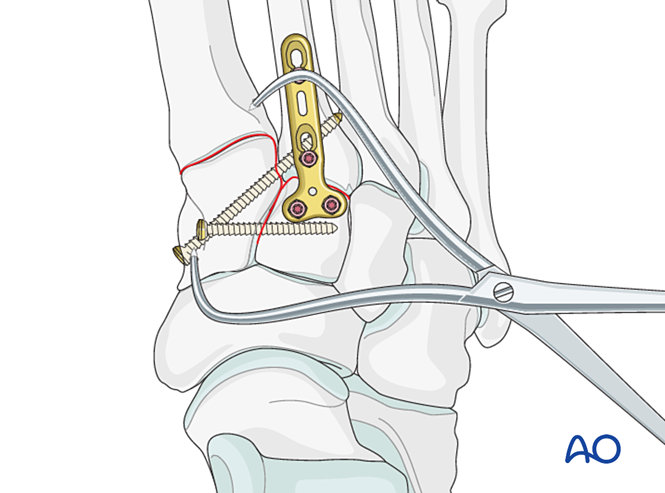Treatment of Lisfranc injuries for Lisfranc injuries