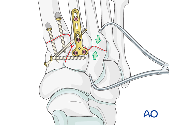 Treatment of Lisfranc injuries for Lisfranc injuries