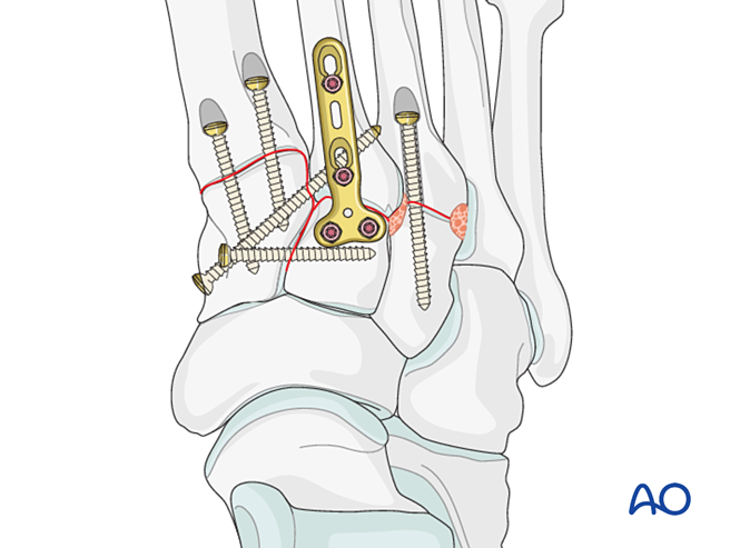 Treatment of Lisfranc injuries for Lisfranc injuries