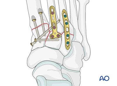 Treatment of Lisfranc injuries for Lisfranc injury