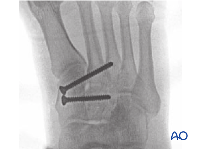 Treatment of Lisfranc injuries for Lisfranc injuries
