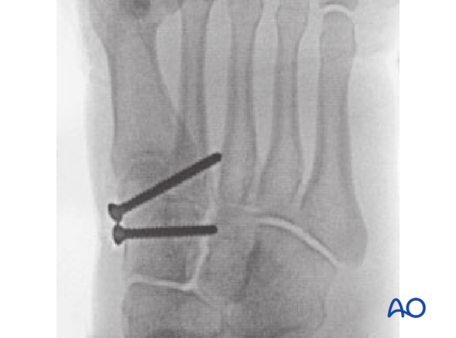 Treatment of Lisfranc injuries for Lisfranc injury
