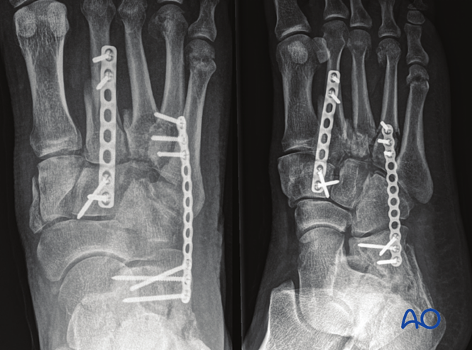 Treatment of Lisfranc injuries for Lisfranc injury