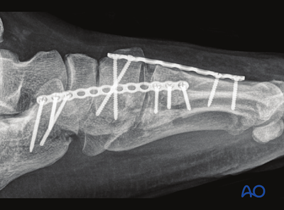 Treatment of Lisfranc injuries for Lisfranc injury