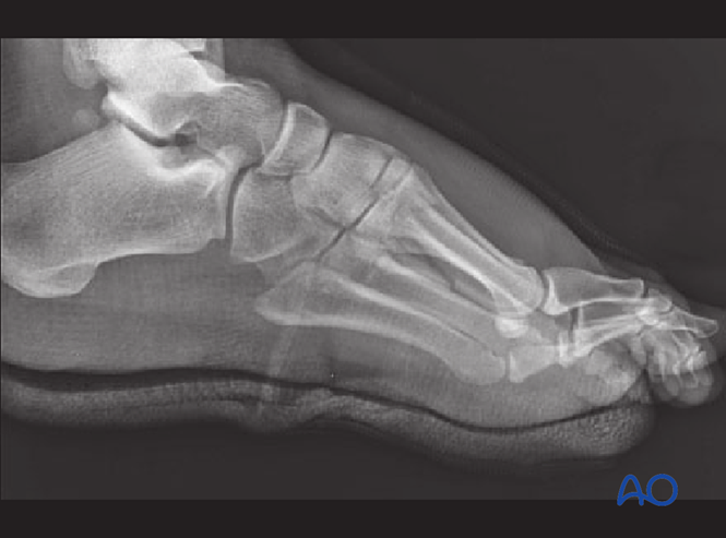 Treatment of Lisfranc injuries for Lisfranc injury