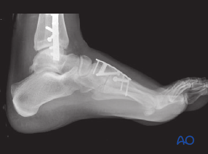 Treatment of Lisfranc injuries for Lisfranc injury