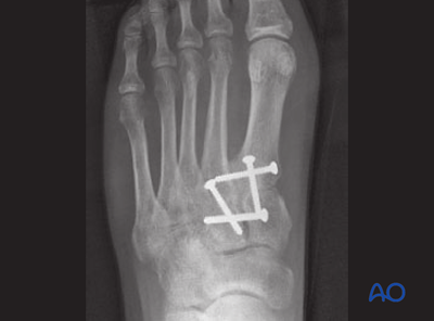 Treatment of Lisfranc injuries for Lisfranc injury