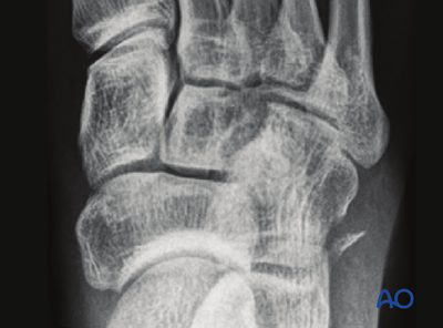 Cuboid avulsion fracture