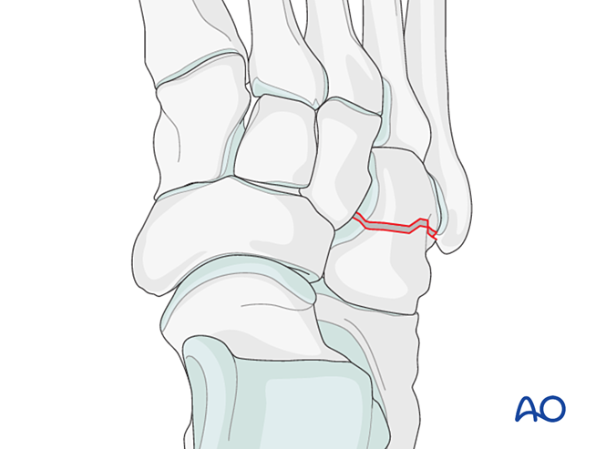 Simple cuboid fracture