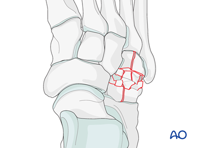Multifragmentary cuboid fracture