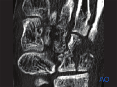 Multifragmentary cuboid fracture