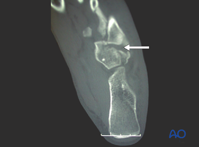 Simple cuboid fracture