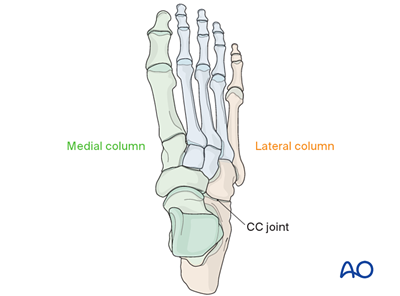 Nonoperative treatment for Cuboid avulsion fracture
