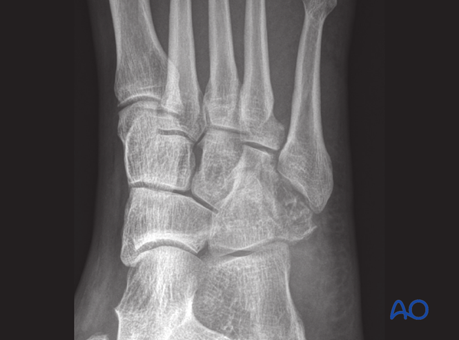 Plate fixation for Multifragmentary cuboid fracture