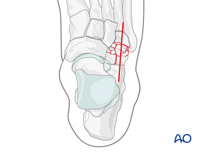 Plate fixation for Multifragmentary cuboid fracture