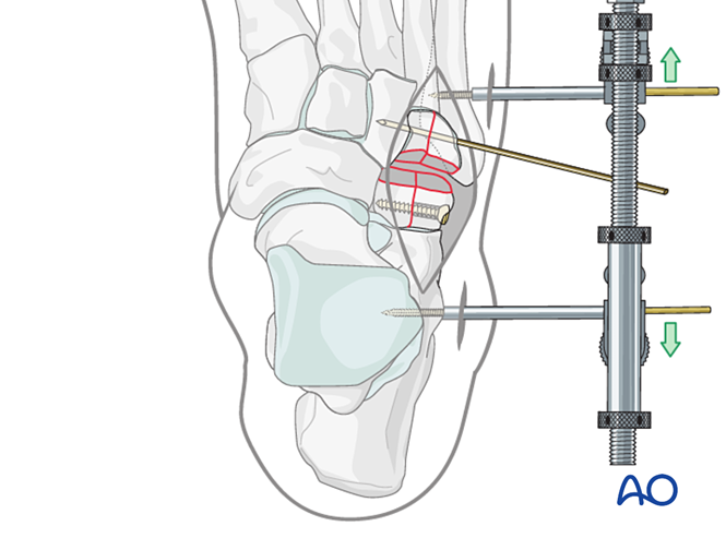 Plate fixation for Multifragmentary cuboid fracture