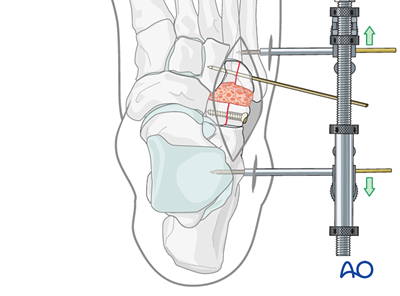 Plate fixation for Multifragmentary cuboid fracture